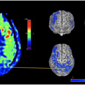 SYMPTOMS OF ANOXIC BRAIN INJURY & HYPOXIC BRAIN INJURY