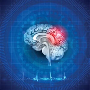 Acceleration And Deceleration Brain Injuries | Whiplash & Traumatic ...