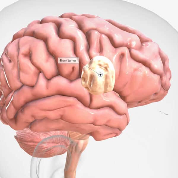 Can A Concussion Cause Memory Loss Brain Injury Law Of Seattle Can A Concussion Cause Memory Loss Brain Injury Law Of Seattle